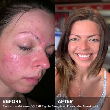 CLEAR Extra Strength Acne Products Kit | Paula's Choice