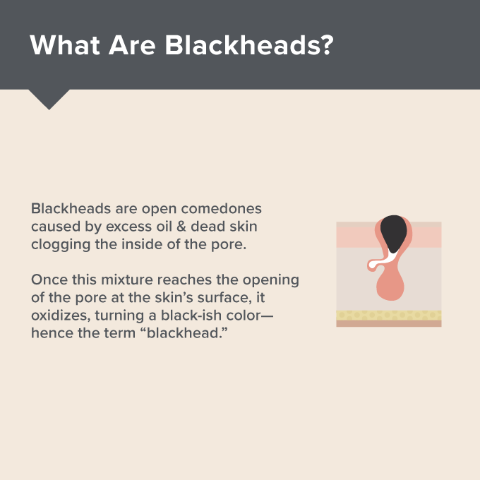 blackhead removal tips