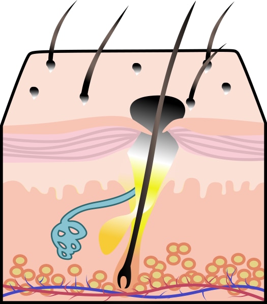 How to Prevent and Get Rid of Blackheads | Paula's Choice